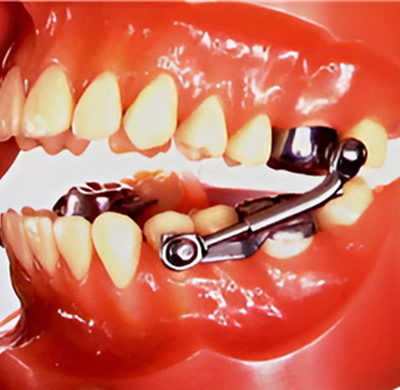 Orthodontic Appliances | Treatment Solutions Dr. Lauren Cai