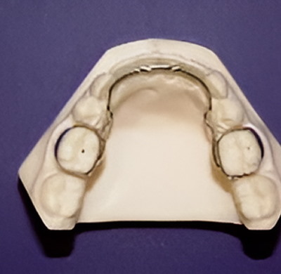 Orthodontic Appliances | Treatment Solutions Dr. Lauren Cai